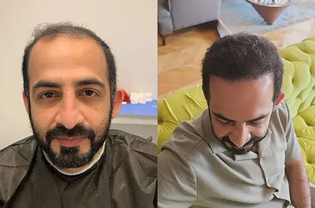 Hair Transplant Training Course 2026 | Dr. Noyan SÜALP
